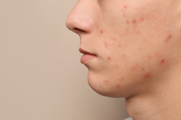 Acne Facial: What It Is, What To Expect, And Benefits | Soothe